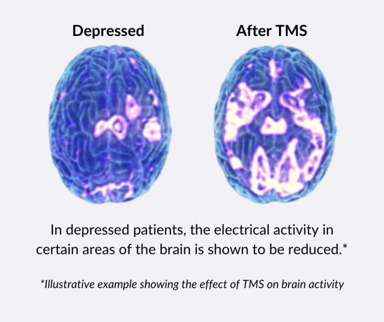Transcranial Magnetic Stimulation (TMS) | Seven Counties Services