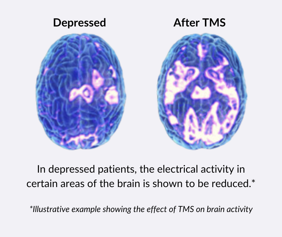 Transcranial Magnetic Stimulation (TMS) | Seven Counties Services
